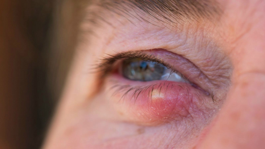 Troubles oculaires | vitagate