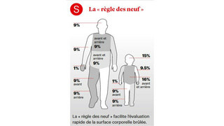 Les 4 types de brûlures et comment agir