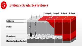Les 4 types de brûlures et comment agir